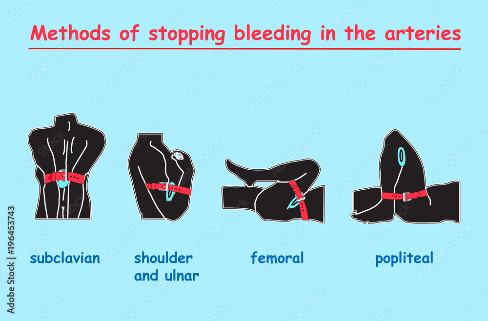 methods of stopping bleeding in the arteries black body. vector info ...