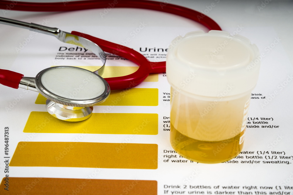 Human Urine Sample Human urine sample waiting for testing, with a ...