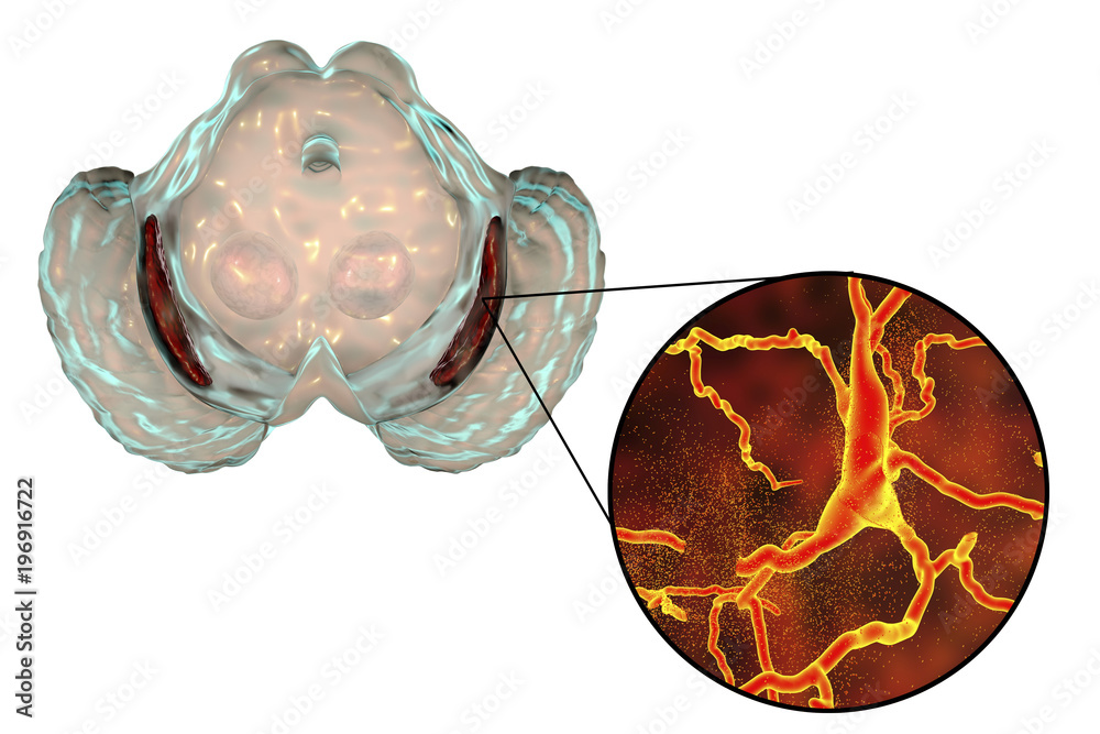 Substantia nigra, a basal banglia of the midbrain, in Parkinson's ...