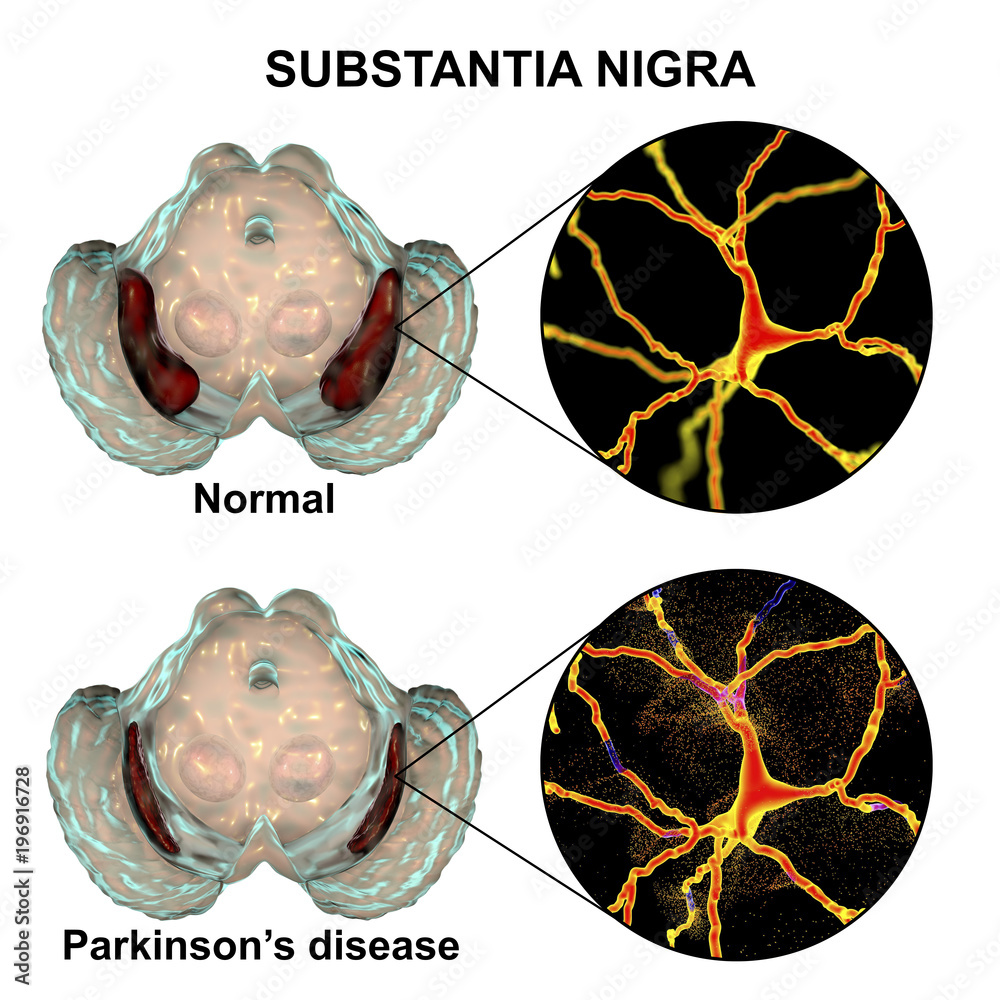 Substantia nigra in norm and in Parkinson's disease, 3D illustration ...