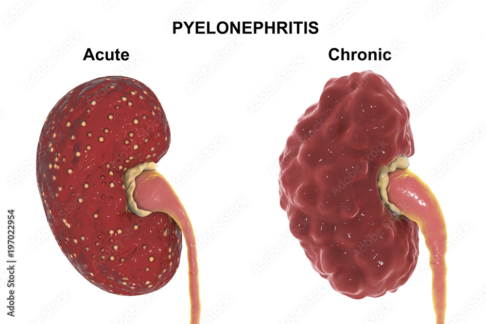 Acute and chronic pyelonephritis, medical concept, 3D illustration ...