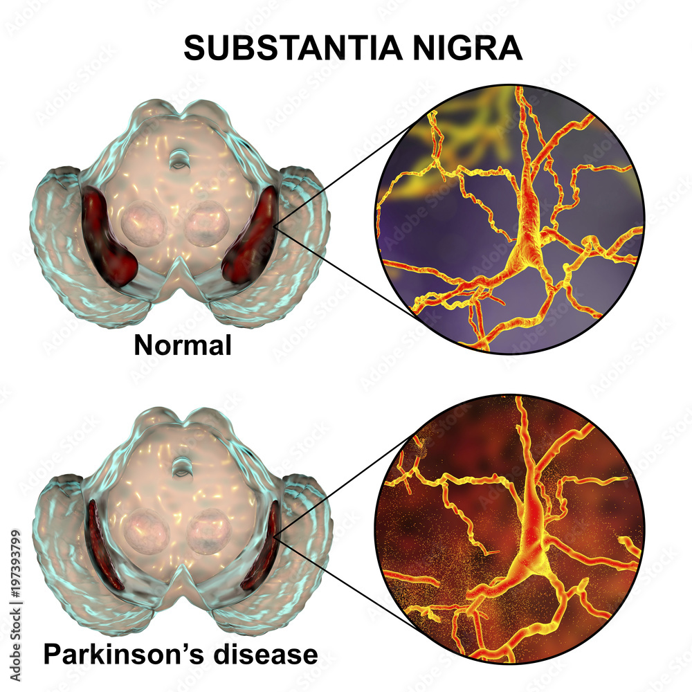 Substantia nigra in norm and in Parkinson's disease, 3D illustration showing decrease of its ...