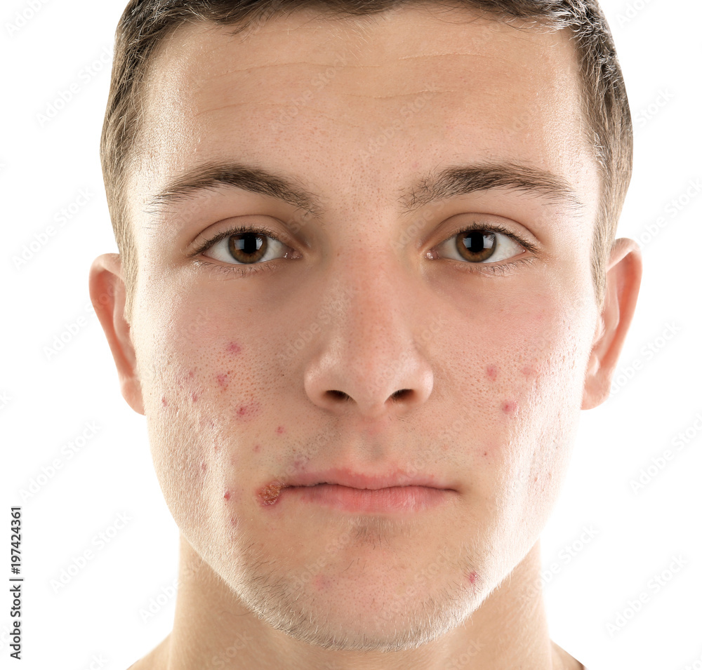 Young man with acne problem on white background Stock Photo | Adobe Stock