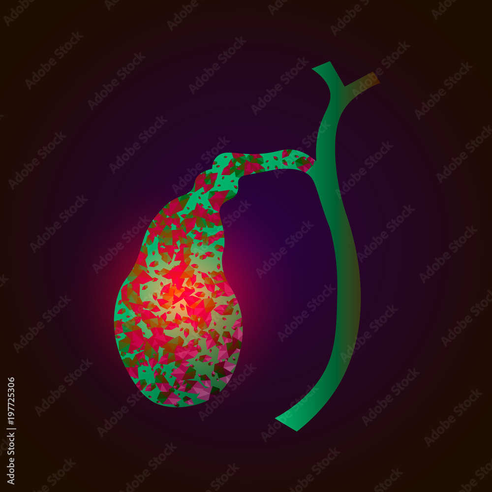 Medical illustration of intestinal Gallbladder, stones in the ...