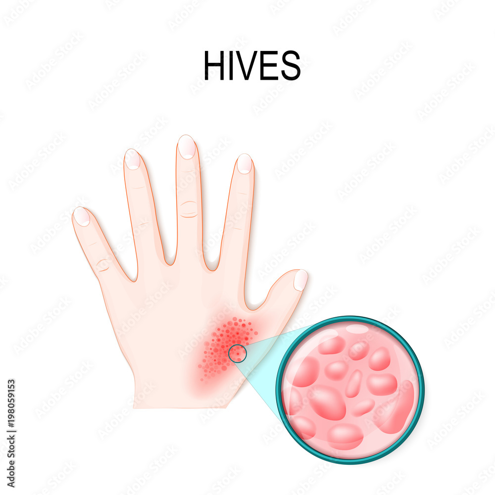 skin rash. Hives or urticaria. Stock Vector | Adobe Stock