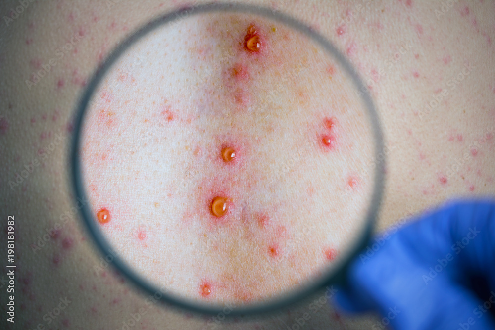 epidemic Varicella viral infection concept. skin bubble rash ภาพถ่าย ...
