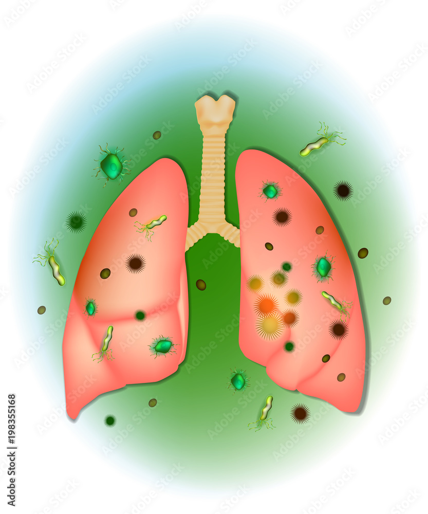 Viral Lung Infections. Influenza virus particles entering the lungs ...