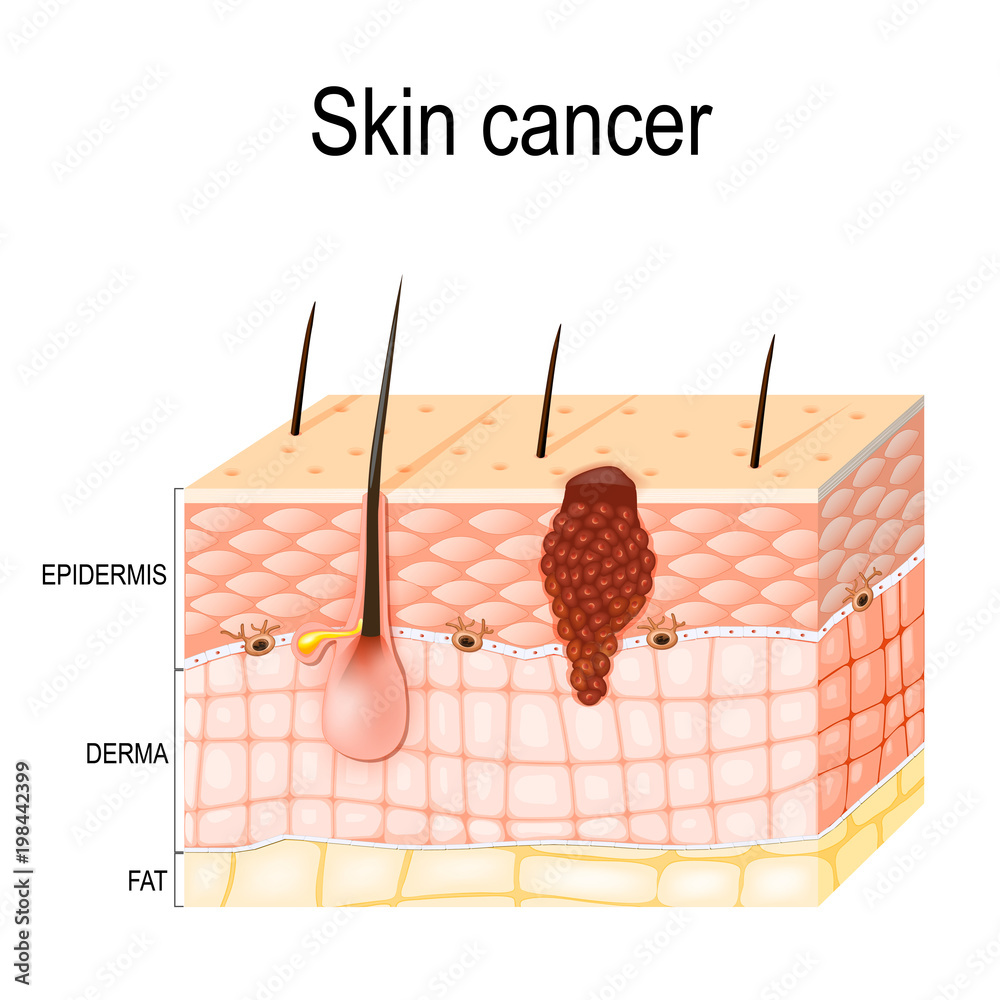 Melanoma. skin cancer Stock Vector | Adobe Stock