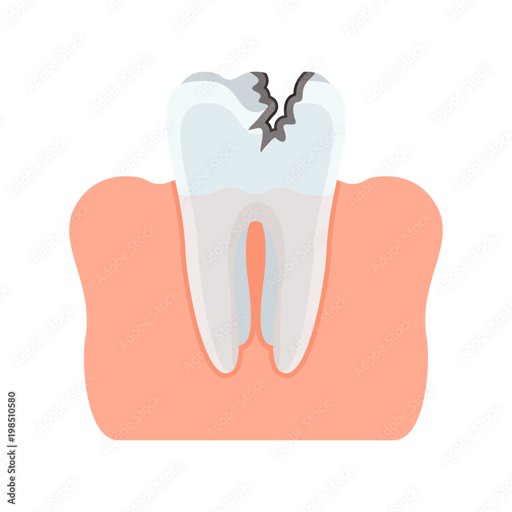 Damaged caries tooth. Flat vector cartoon illustration. Objects ...