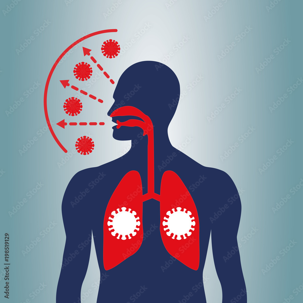 Sars disease-illustration Stock Vector | Adobe Stock
