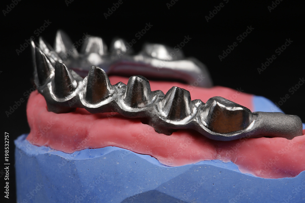metal frame dental prosthesis dressed on the model, shot on the side ...