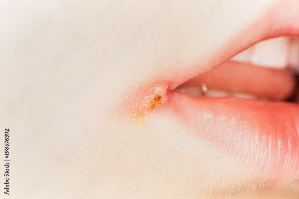 Bacterial Infection On Lips