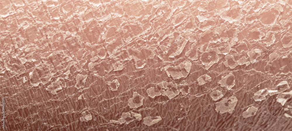 human skin epidermis texture with flaking and cracked particles close ...
