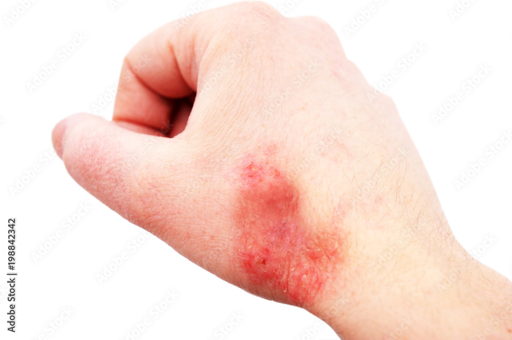 Atopic Dermatitis Ad Also Known As Atopic Eczema Is A Type Of Inflammation Of The Skin