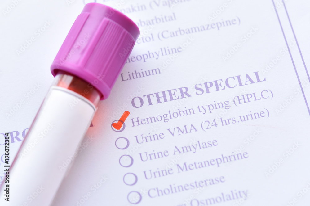 Blood sample for hemoglobin typing test, diagnosis for thalassemia ...