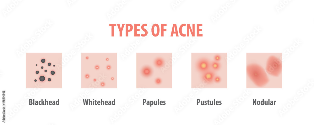 Types of acne diagram illustration vector on white background, Beauty ...