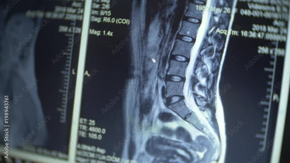 Close. MRI X-ray images. results of magneto resonance therapy on the ...