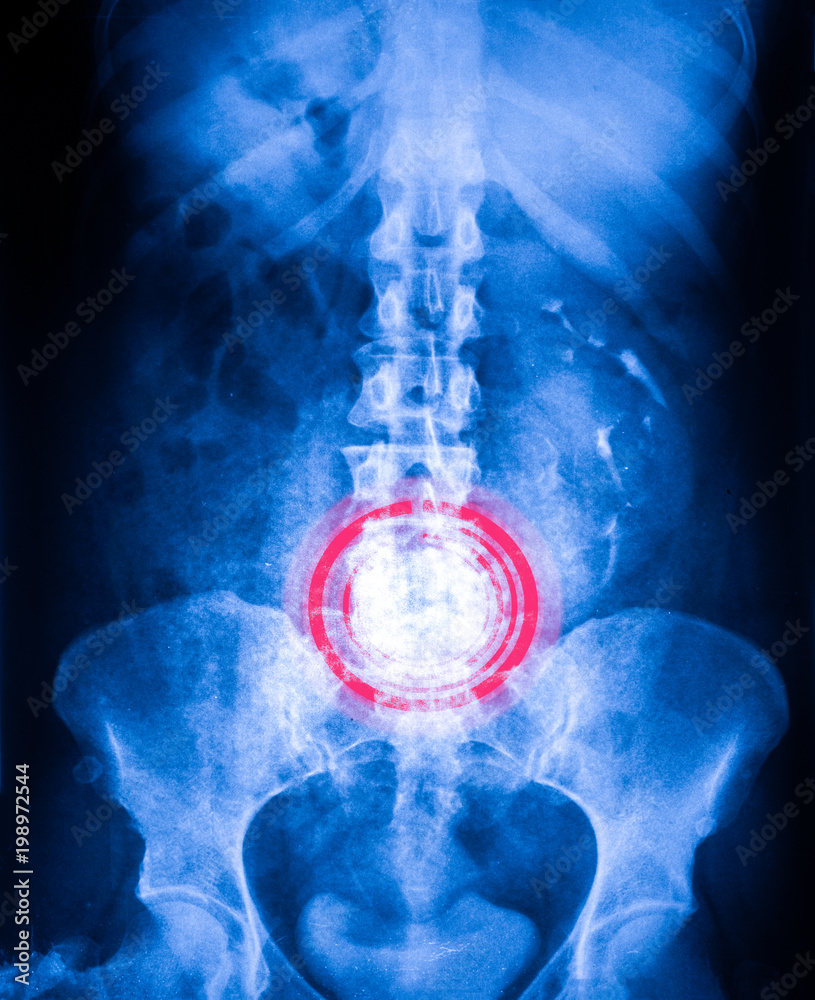 Xray of stomah and pelvis section Stock Photo | Adobe Stock