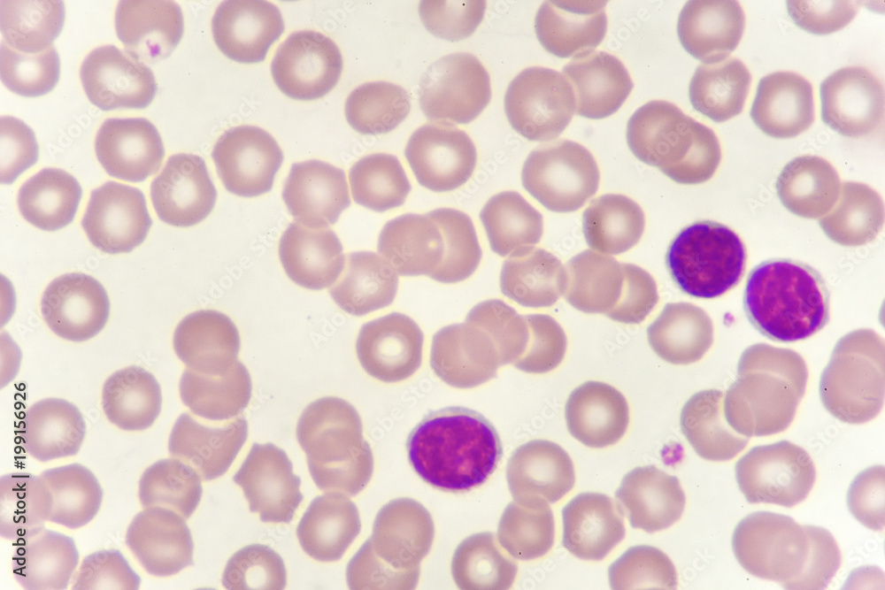 Blood smear of chronic lymphocytic leukemia (CLL), analyze by ...