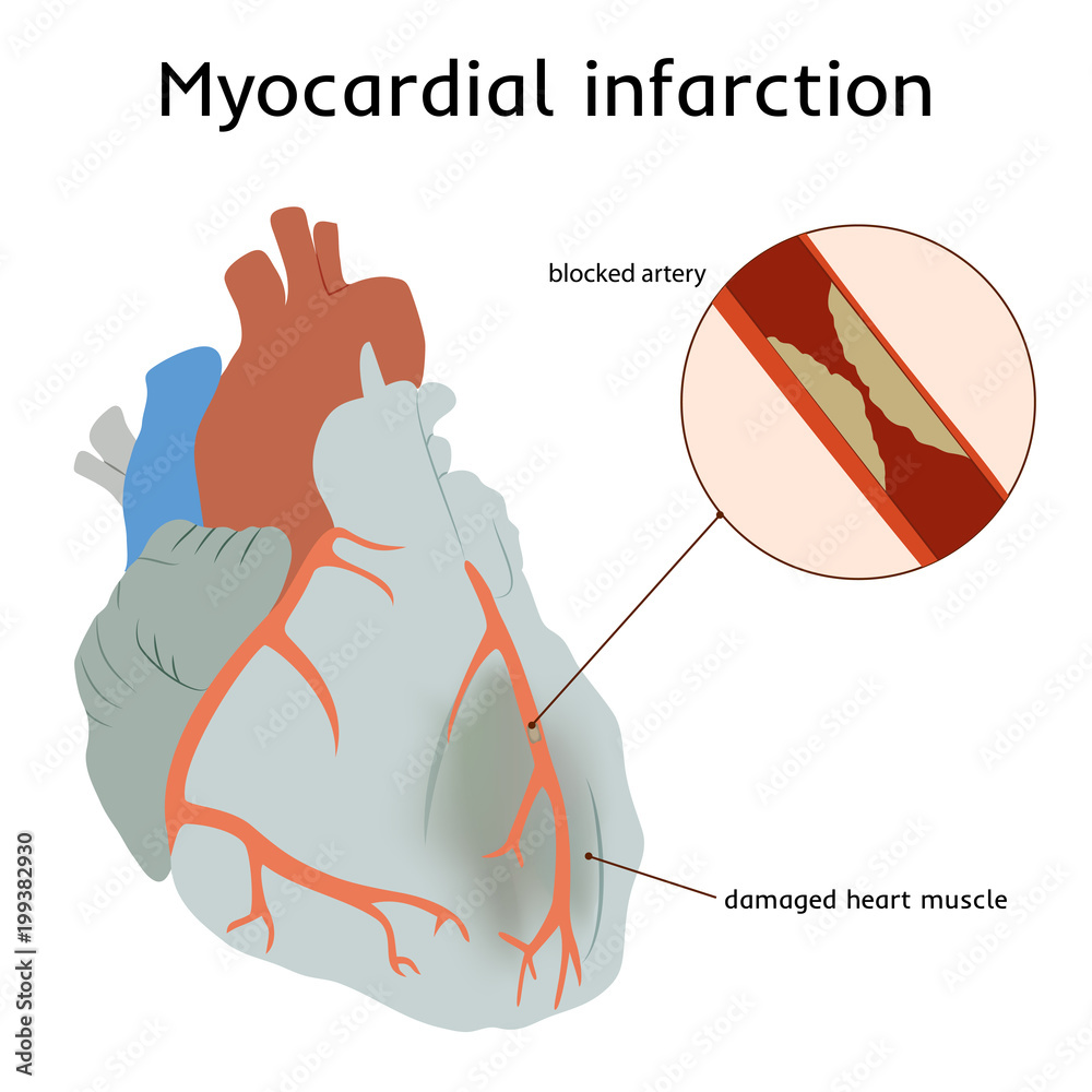 Myocardial infarction. Heart attack. Blocked artery, damaged heart ...