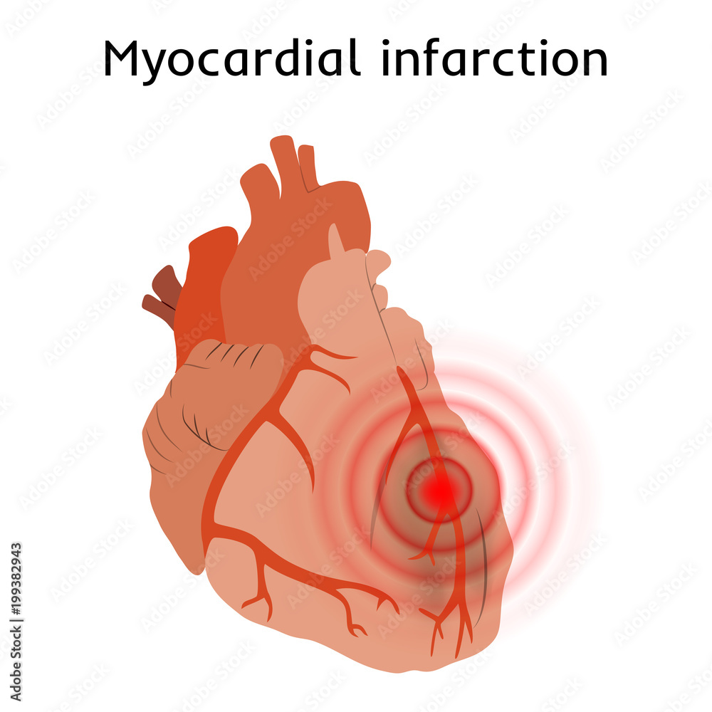 Myocardial infarction. Heart attack, pain. Damaged heart muscle ...