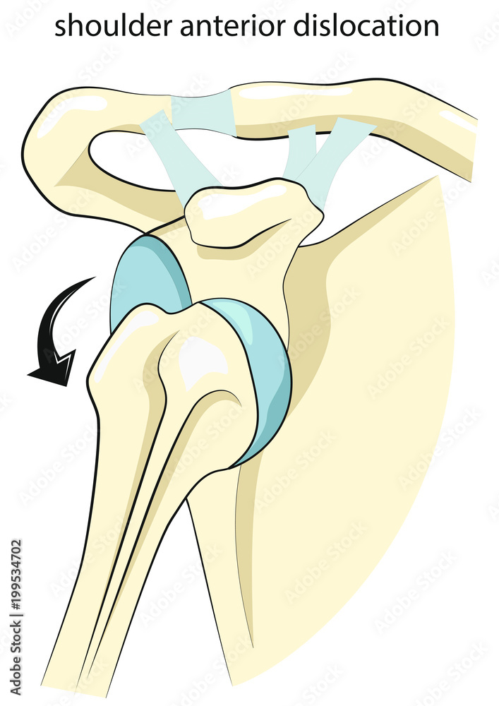 Shoulder anterior dislocation Stock Vector | Adobe Stock