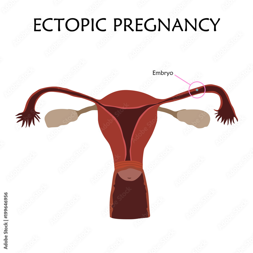 Ectopic pregnancy. The fertilized egg, uterus, womb. Anatomy flat ...