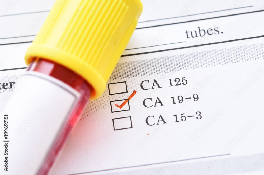 Blood sample for CA19-9 test, tumor marker for pancreatic cancer Stock ...