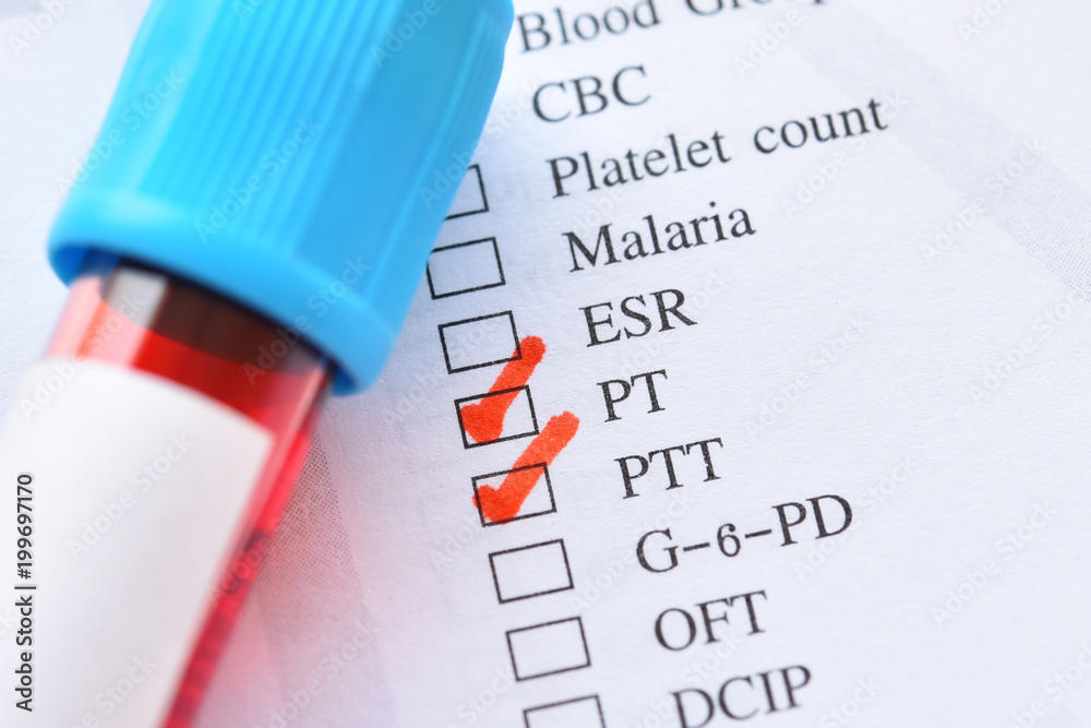 Blood sample for PT and PTT test, coagulation disorder diagnosis Stock ...