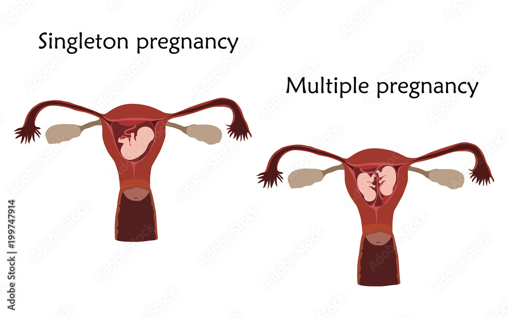 Multiple and singleton pregnancy, twins, embryo, fetus in uterus ...