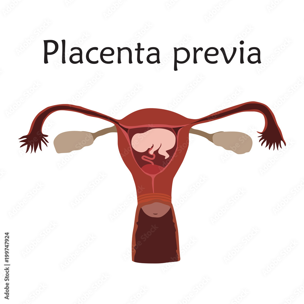 Placenta previa. Embryo, fetus in uterus, placenta, umbilical cord ...