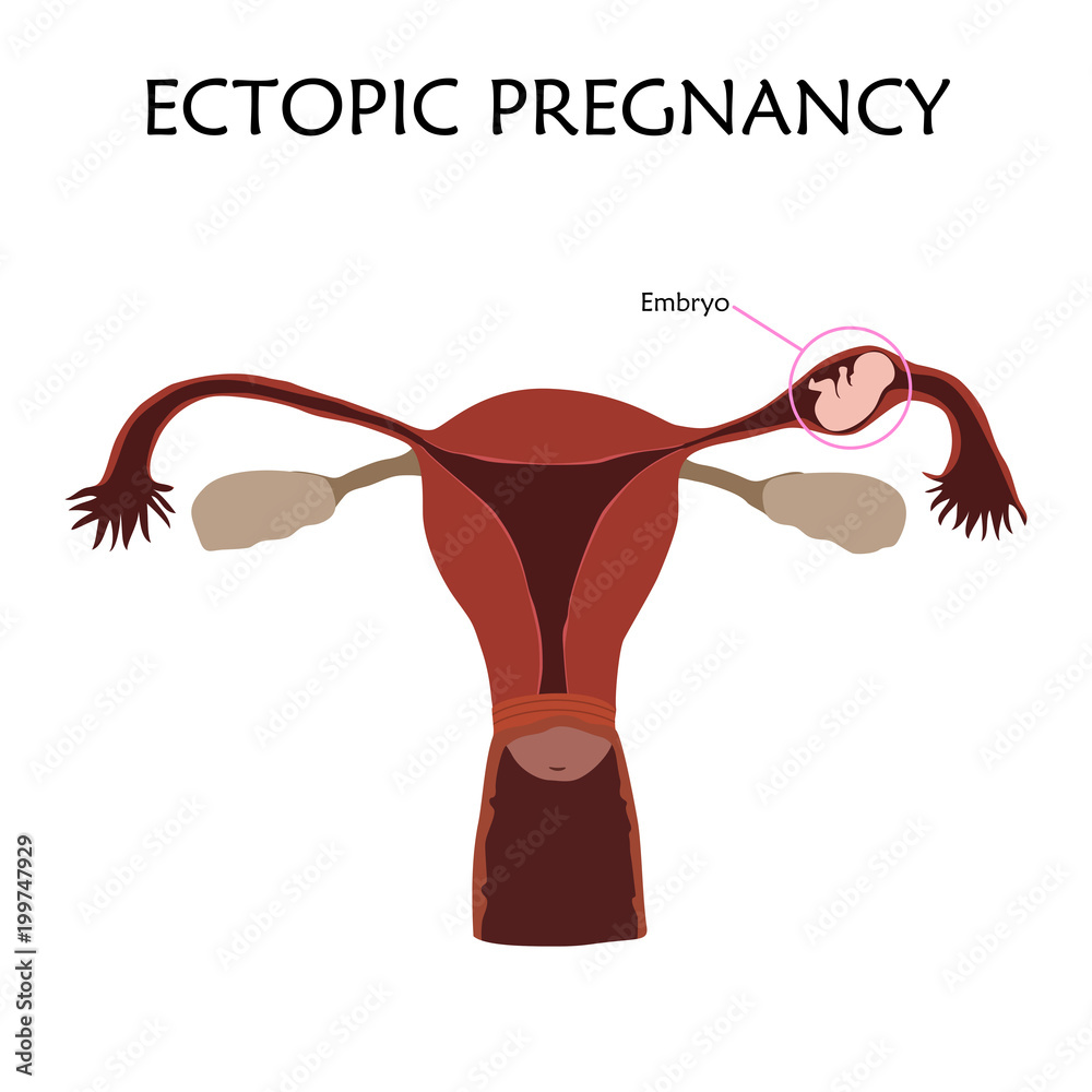 Ectopic pregnancy. Embrio, fetus in fallopian tube, uterus, womb ...