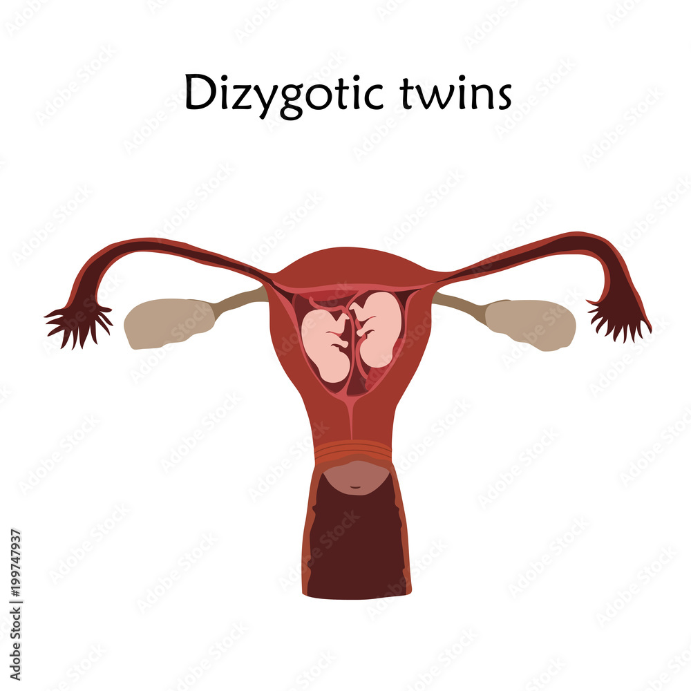 Multiple pregnancy. Dizygotic twins, embryo, fetus in uterus, placenta ...