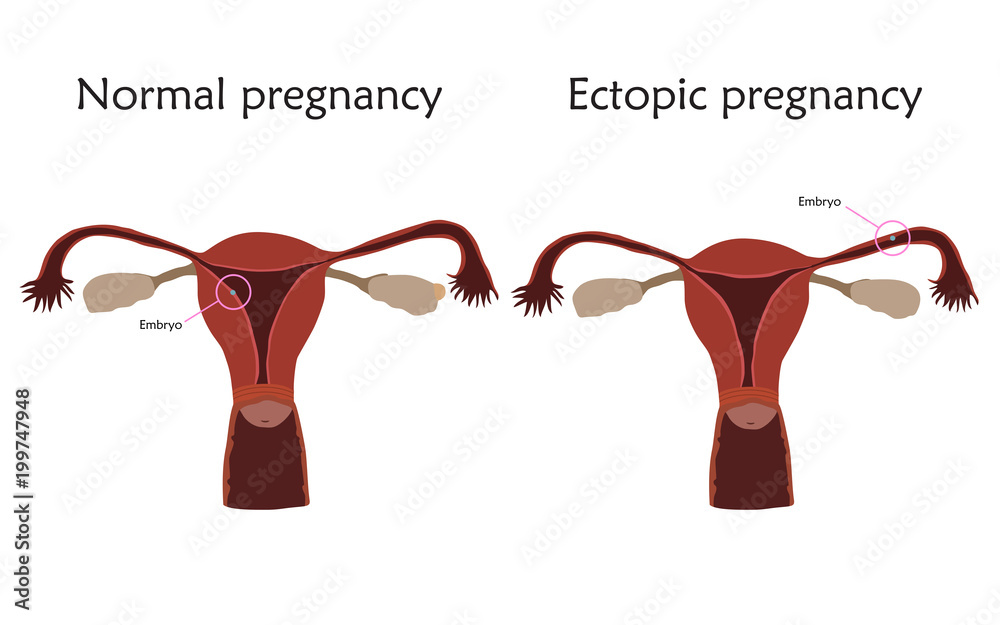 Ectopic and normal pregnancy. The fertilized egg, uterus, womb. Anatomy ...