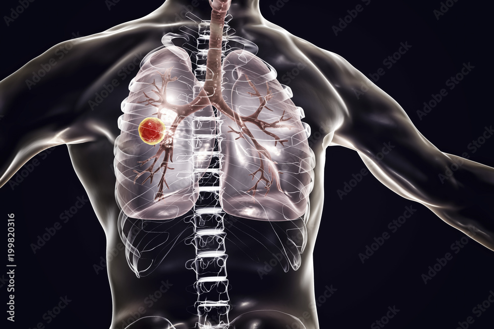 Fibrous-cavernous pulmonary tuberculosis, 3D illustration showing ...