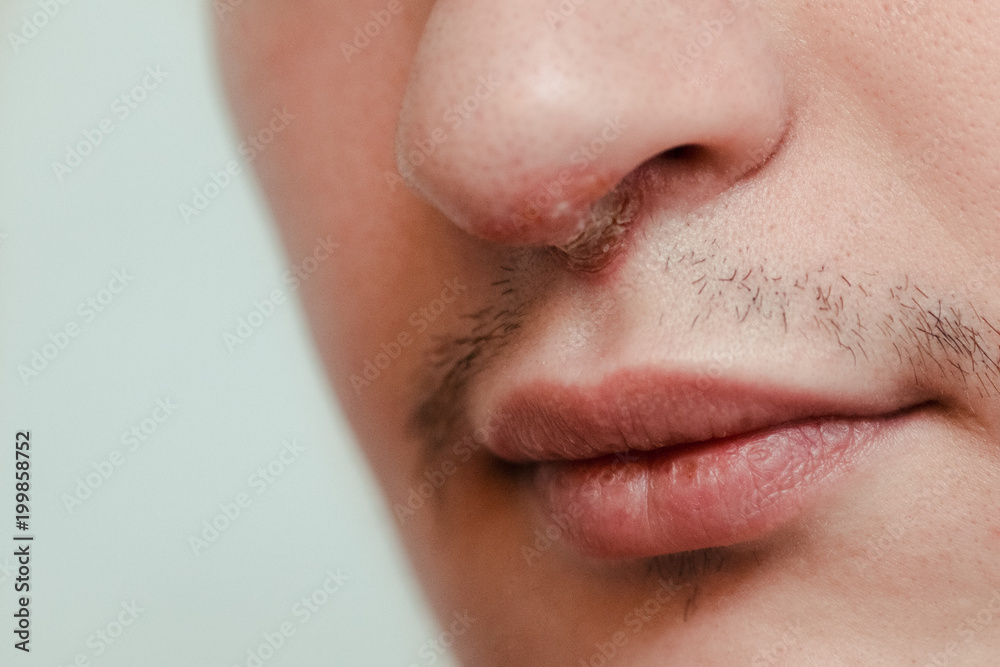 Cold Sore In Nose