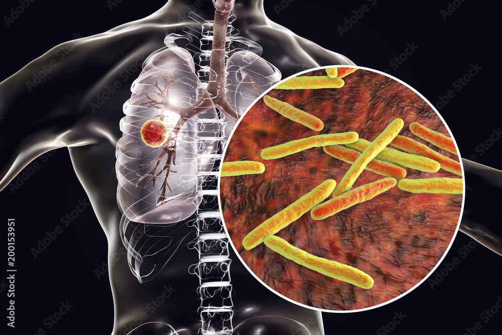 Fibrous-cavernous pulmonary tuberculosis and close-up view of ...