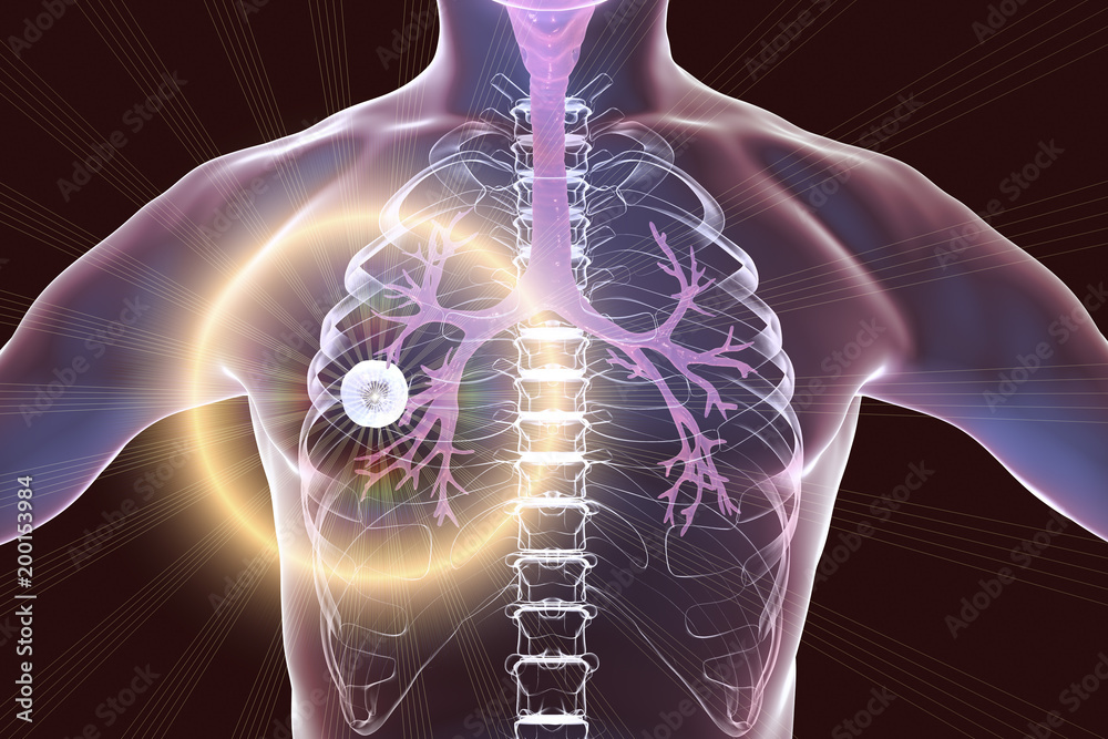 Pulmonary Tuberculosis Cavity