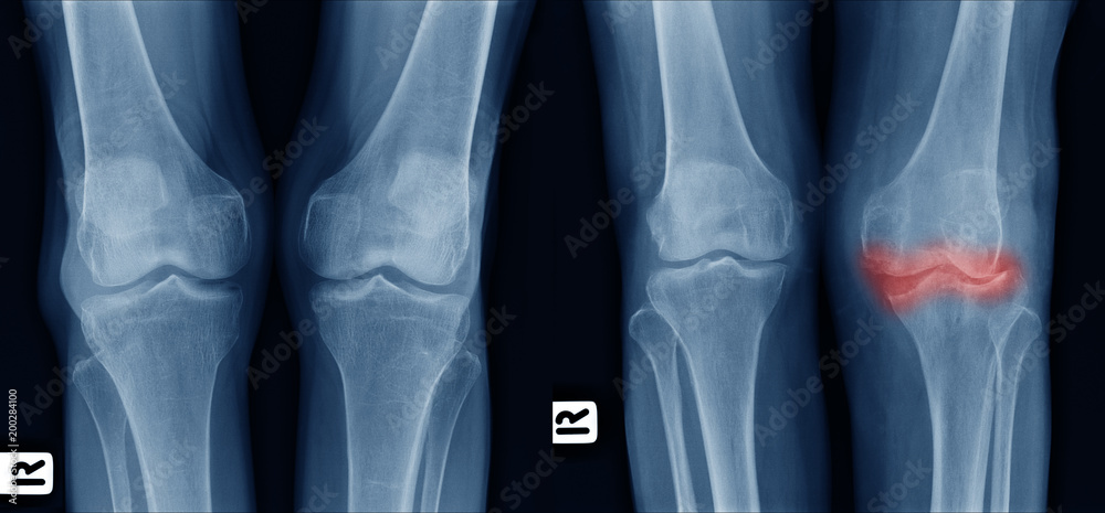 X-ray image show comparison of older normal knee on left side and ...