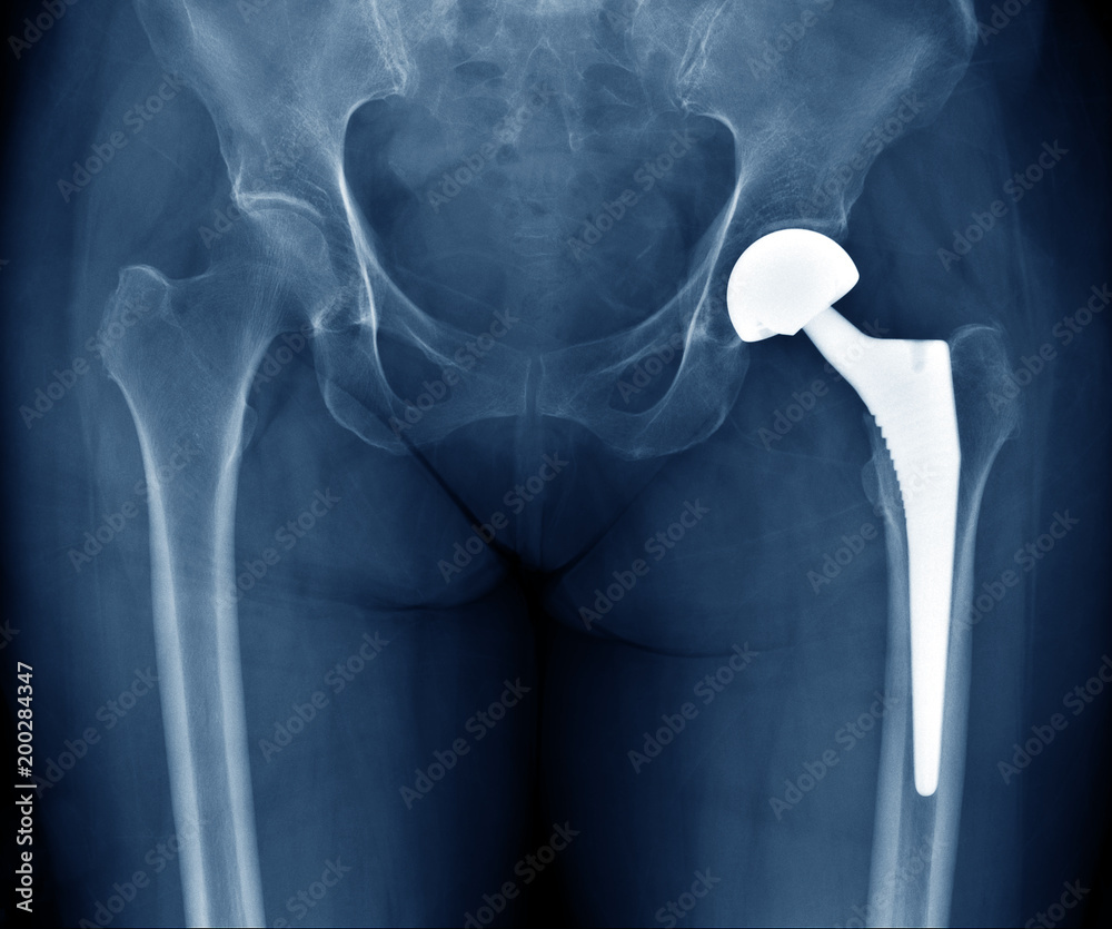 Foto de X-ray scan image of hip joints with orthopedic hip joint ...