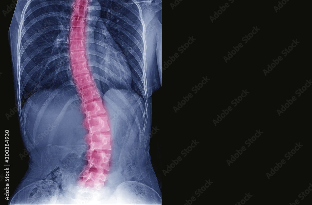 X-ray image of teenager patient spine show Scoliosis and spinal bend in ...