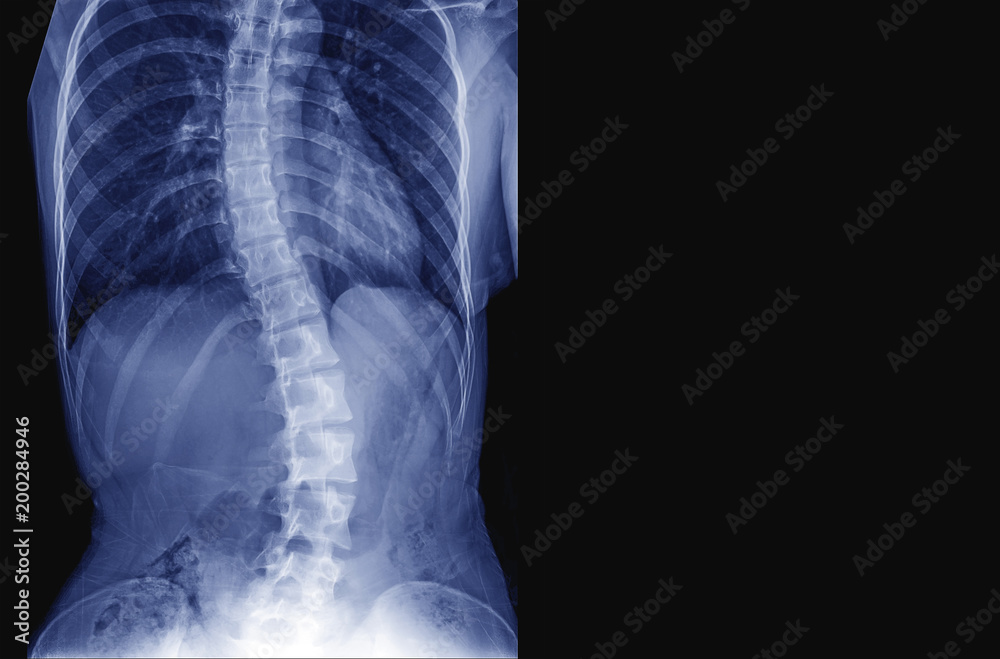 X-ray image of teenager patient spine show Scoliosis and spinal bend in ...