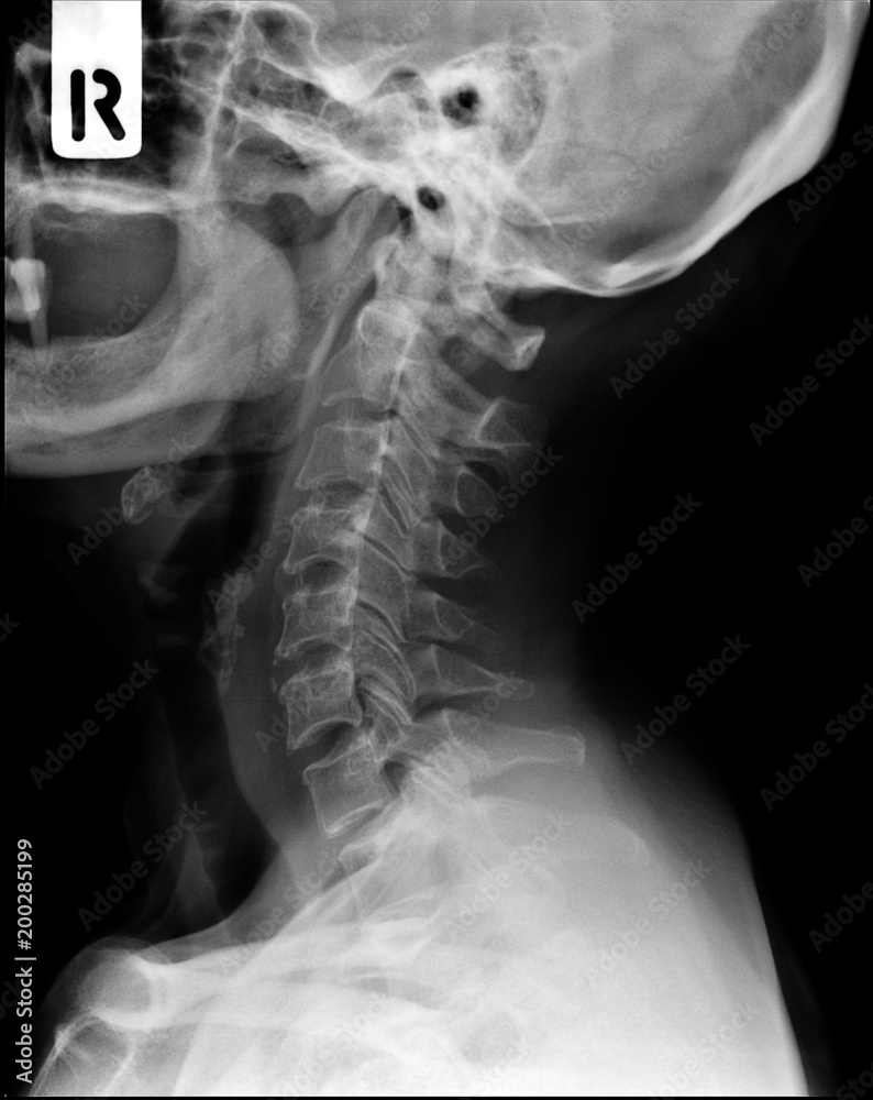 X-ray of neck and cervical spine, side view. Stock Photo | Adobe Stock