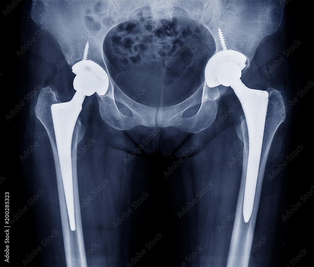 total hip replacement, osteoarthritis of hip joint , artificial hip ...
