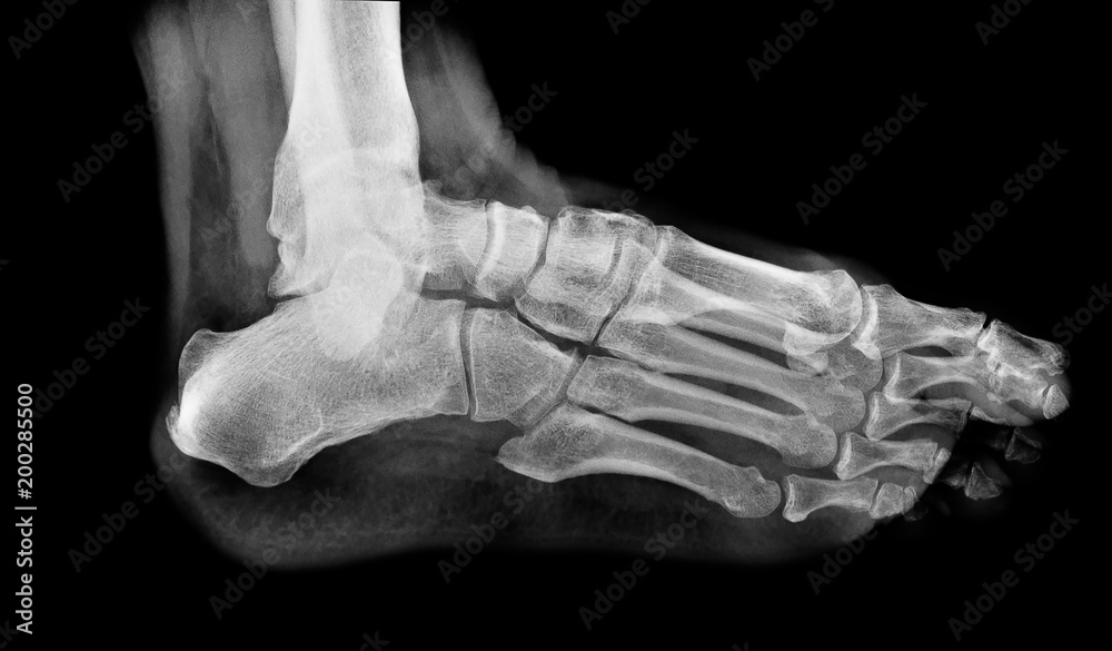 x ray , x-ray image photo of feet side / lateral view. Stock Photo ...