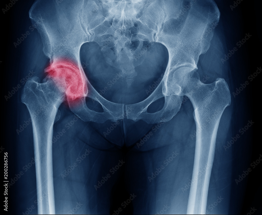 X-ray image of painful hip in woman present Osteoarthritis right hip ...
