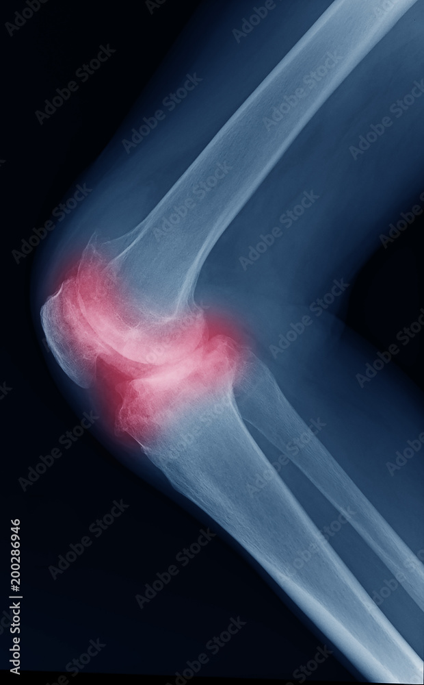 Osteoarthritis Knee ( OA Knee ). Film x-ray both knee ( front view ...