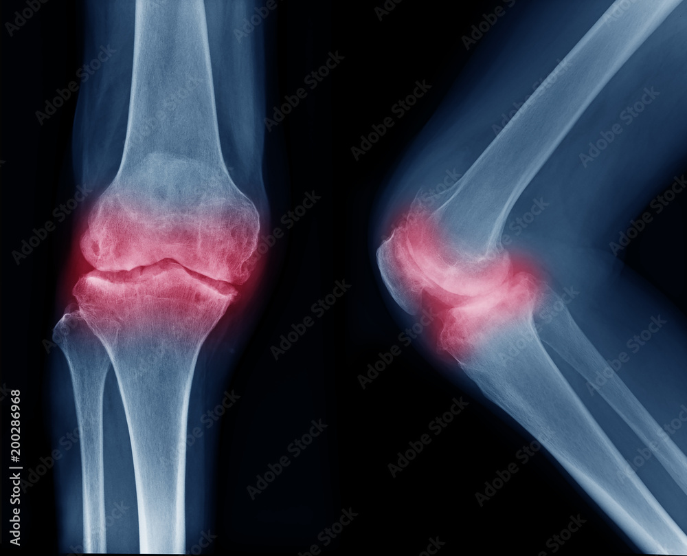 Osteoarthritis Knee Oa Knee Film X Ray Both Knee Front View Show Narrow Joint Space