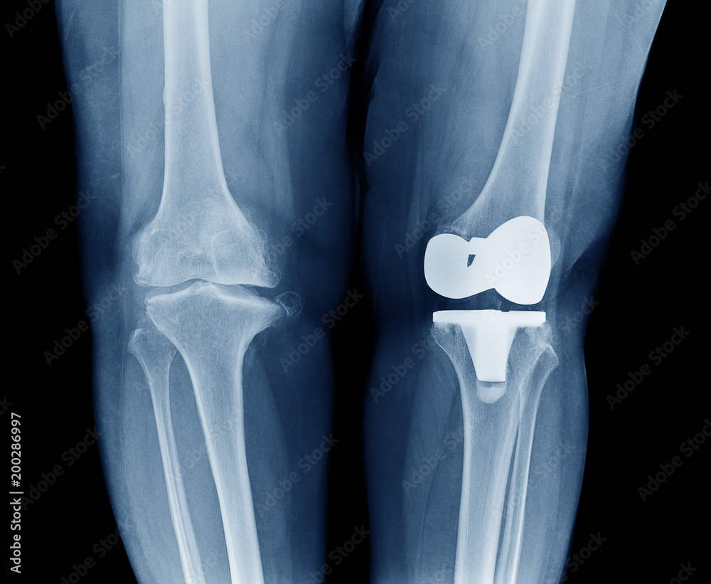 Osteoarthritis Knee ( OA Knee ) comparison on left arthroplasty / total ...