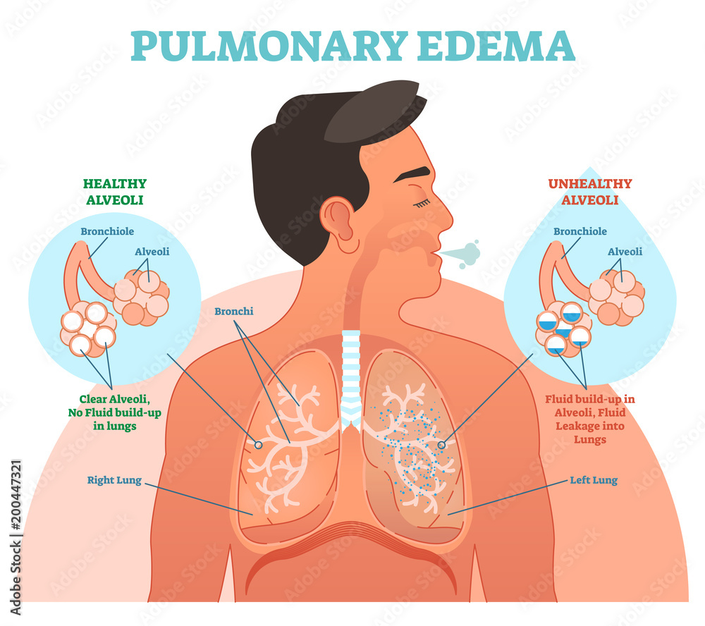 Pulmonary edema, lung problem vector illustration diagram Stock Vector ...